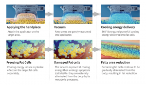 Fat Freezing Does it Work? Pros & Cons (2023) - Bio Aesthetic