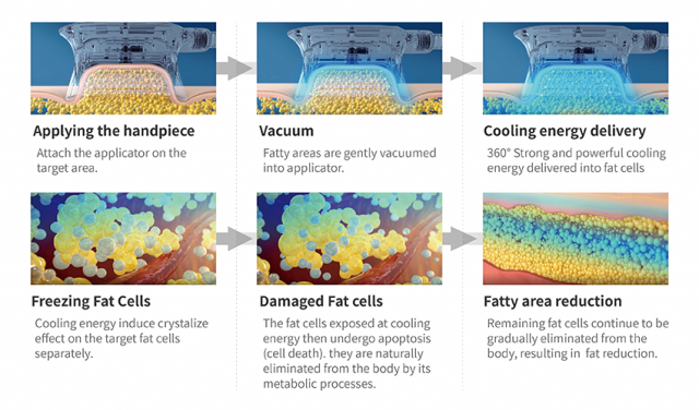 Fat Freezing Does it Work? Pros & Cons (2023) - Bio Aesthetic