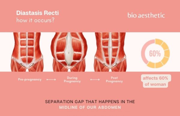 Diastasis Recti Symptoms, and Treatment in Singapore - Bio Aesthetic