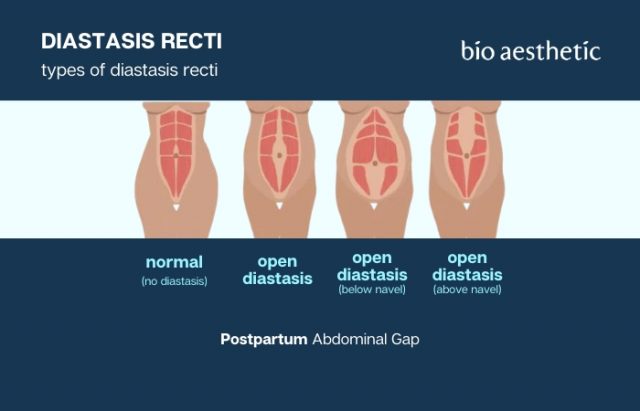Diastasis Recti Symptoms, and Treatment in Singapore - Bio Aesthetic